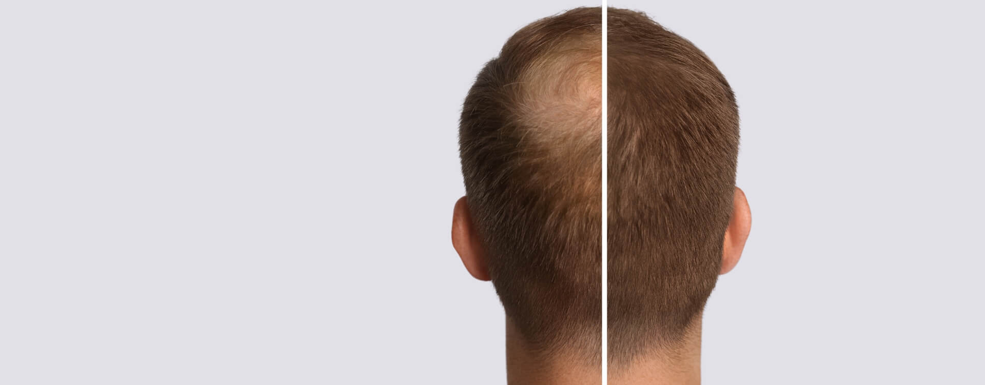 Calecim | PHI Clinic London