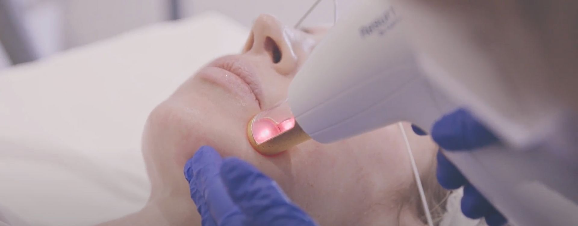 M22 | IPL | Fractional Laser Resurfacing | PHI Clinic London