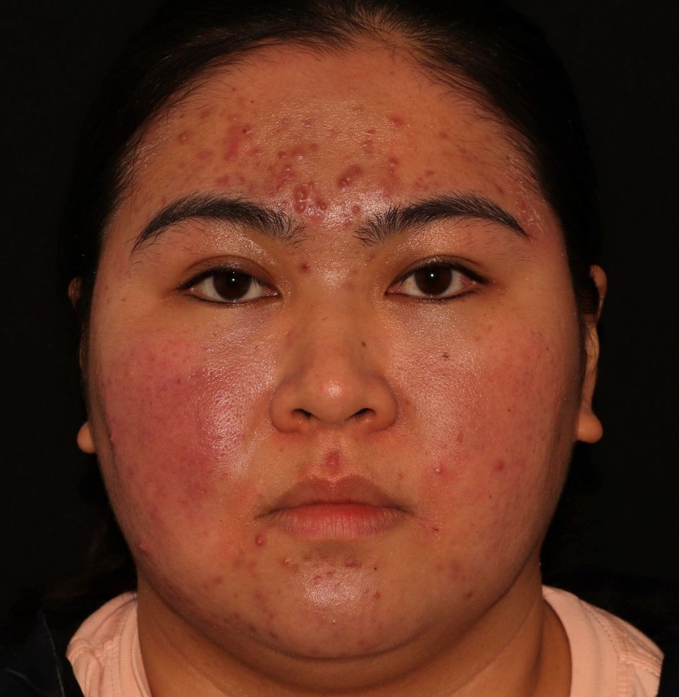Severe Acne Before And After